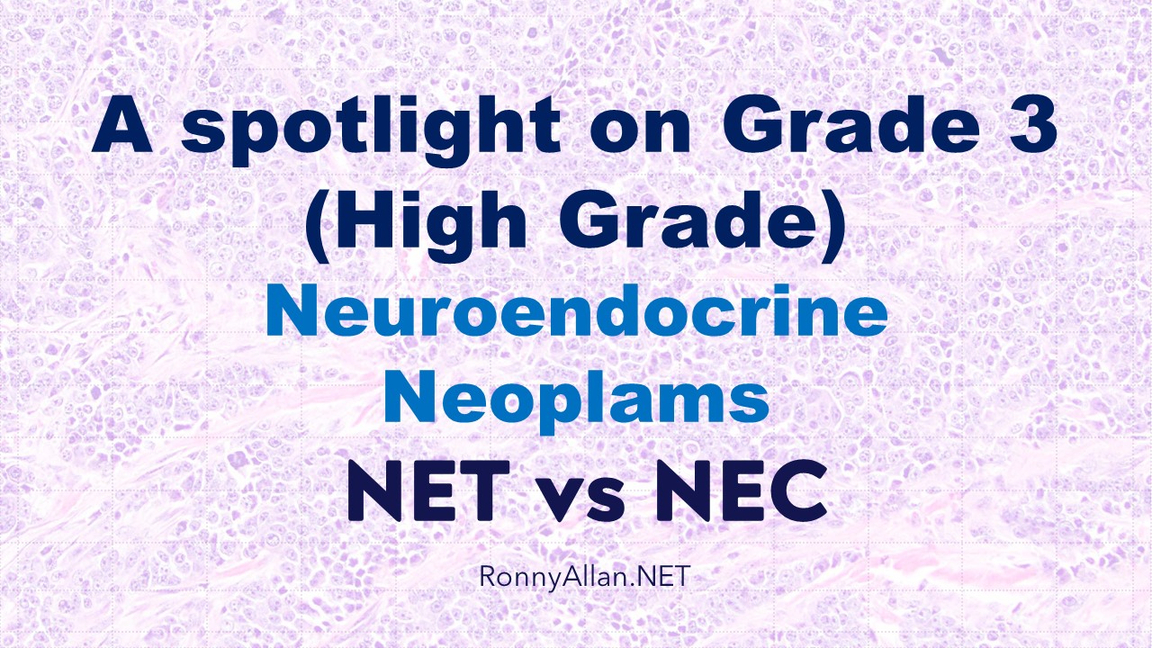 A spotlight on Grade 3 (High grade) Neuroendocrine Neoplasms - Ronny ...