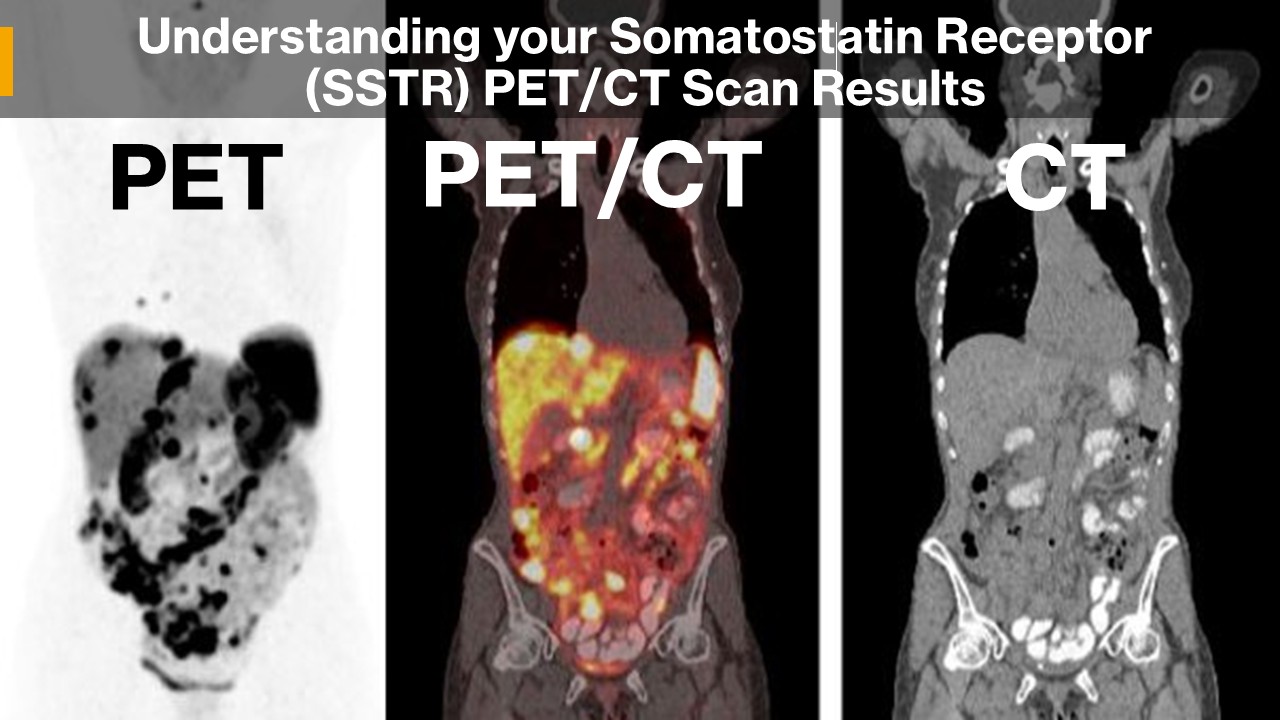 Understanding your Somatostatin Receptor (SSTR) PET/CT Scan Results ...